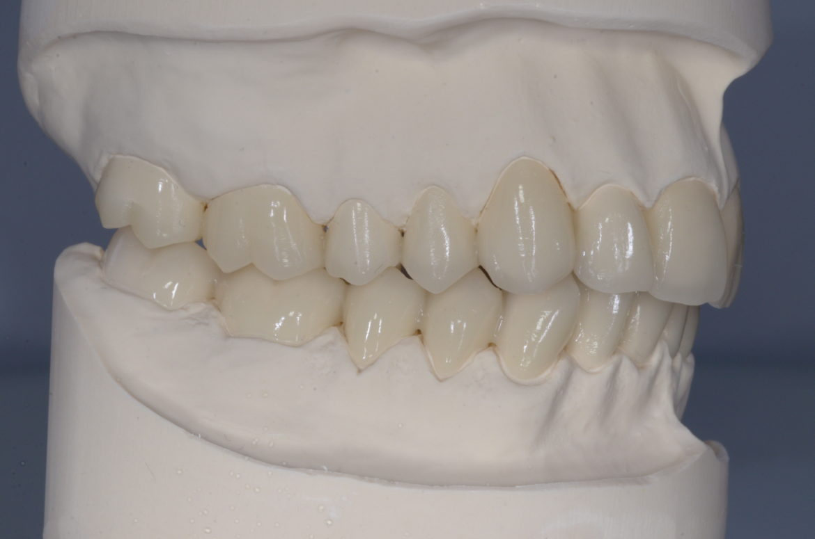 Provisorien - Dental Studio München