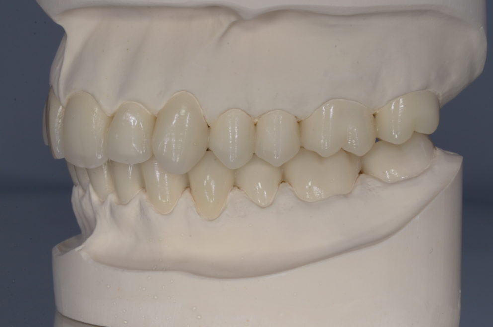 Provisorien - Dental Studio München